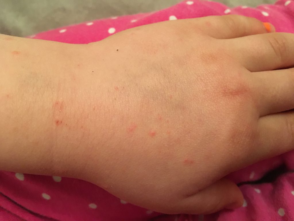 Hand-Mund-Fuß-Krankheit – Hand-Foot-Mouth-Disease – BerlOndon-Mama
